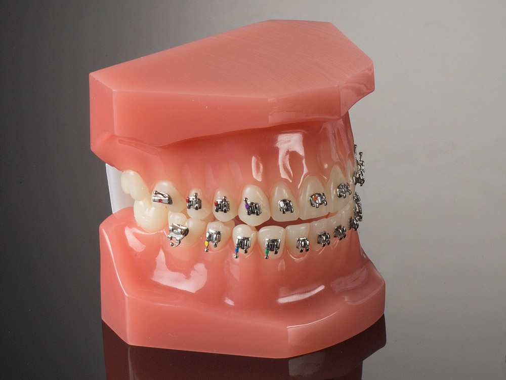 MiniPrevail® TWIN Bracket System - Bao Chau Dental